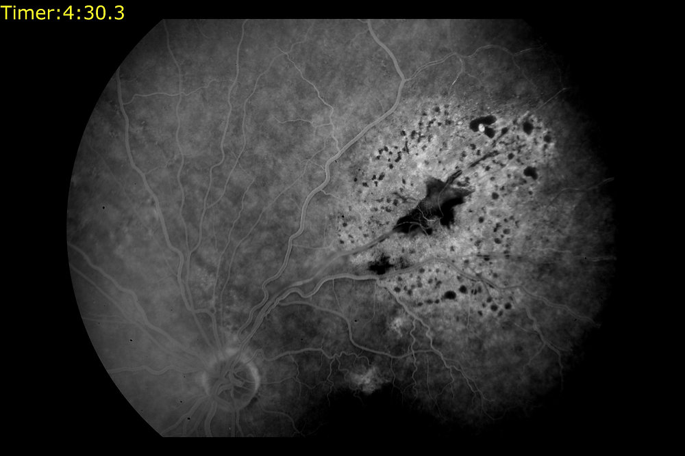 Pigmented Paravenous Retinochoroidal Atrophy