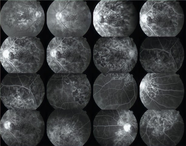 Relentless Placoid Chorioretinitis