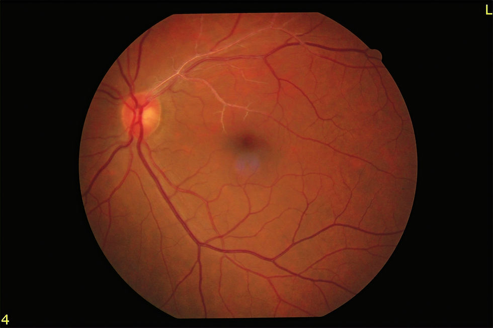 Kyrieleis Plaques, retinal vascular diseases,