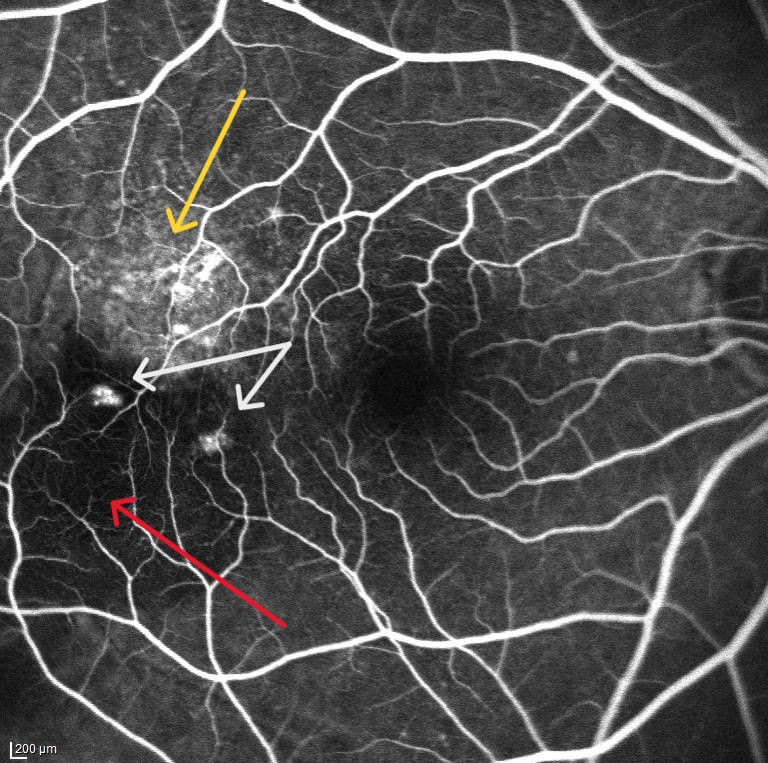 Polypoidal Choroidal Vasculopathy