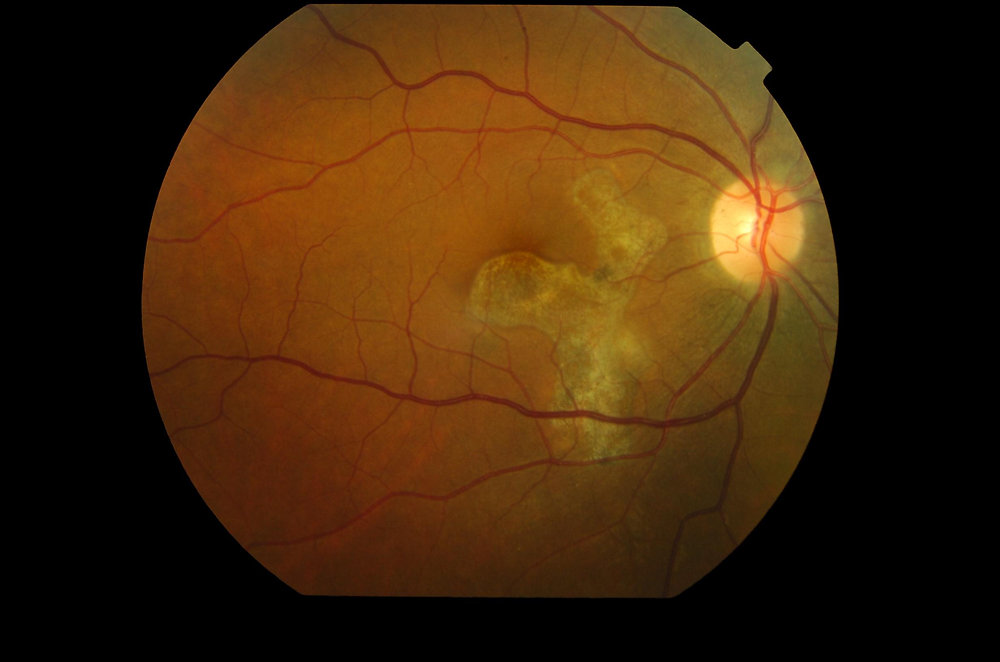 Macular Serpiginous Choroiditis