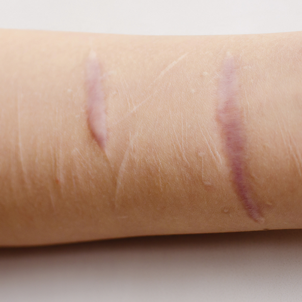 Microneedling for Injury-related Scars | Scar Resurfacing in Weston ...