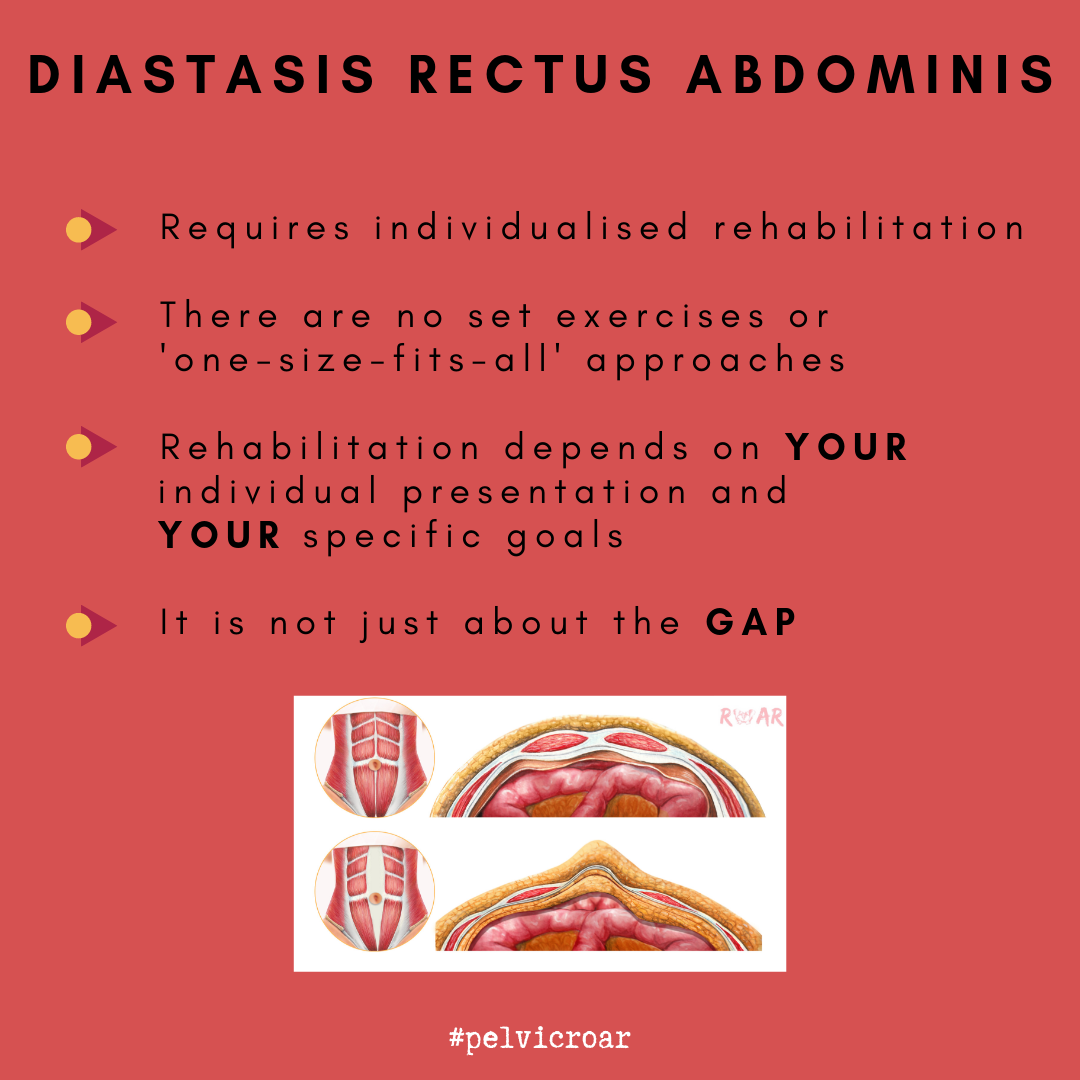 Rectus Diastasis - Images | Pelvicroar
