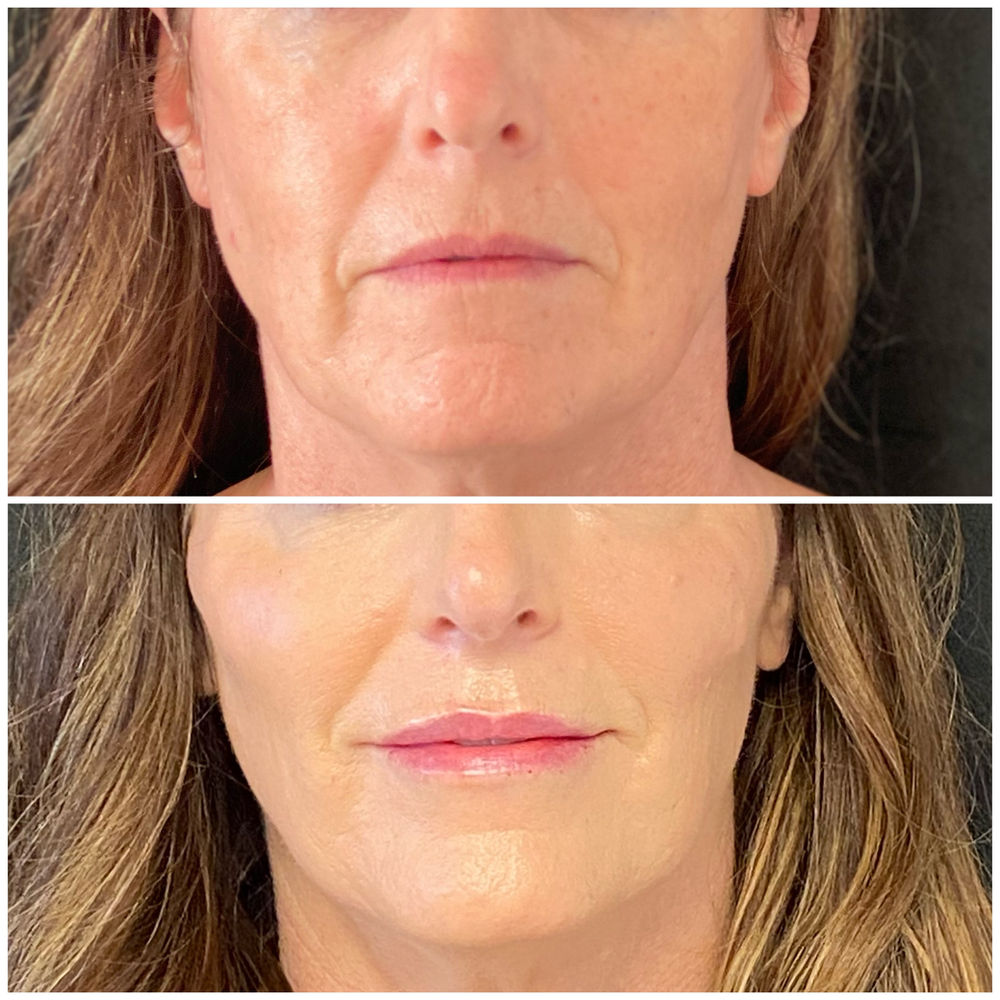 Full Face Correction aka The Liquid FaceLift