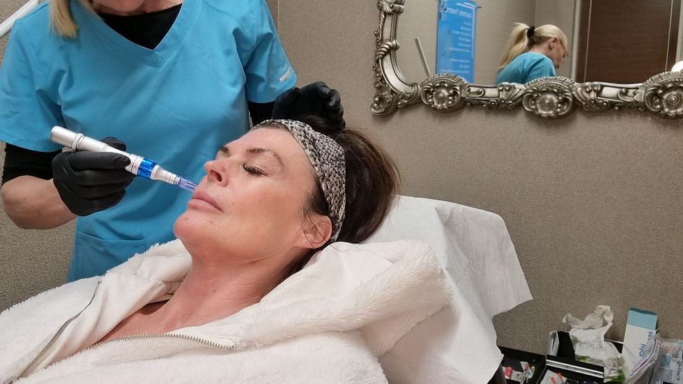 The Benefits of Micro-needling to improve the skin