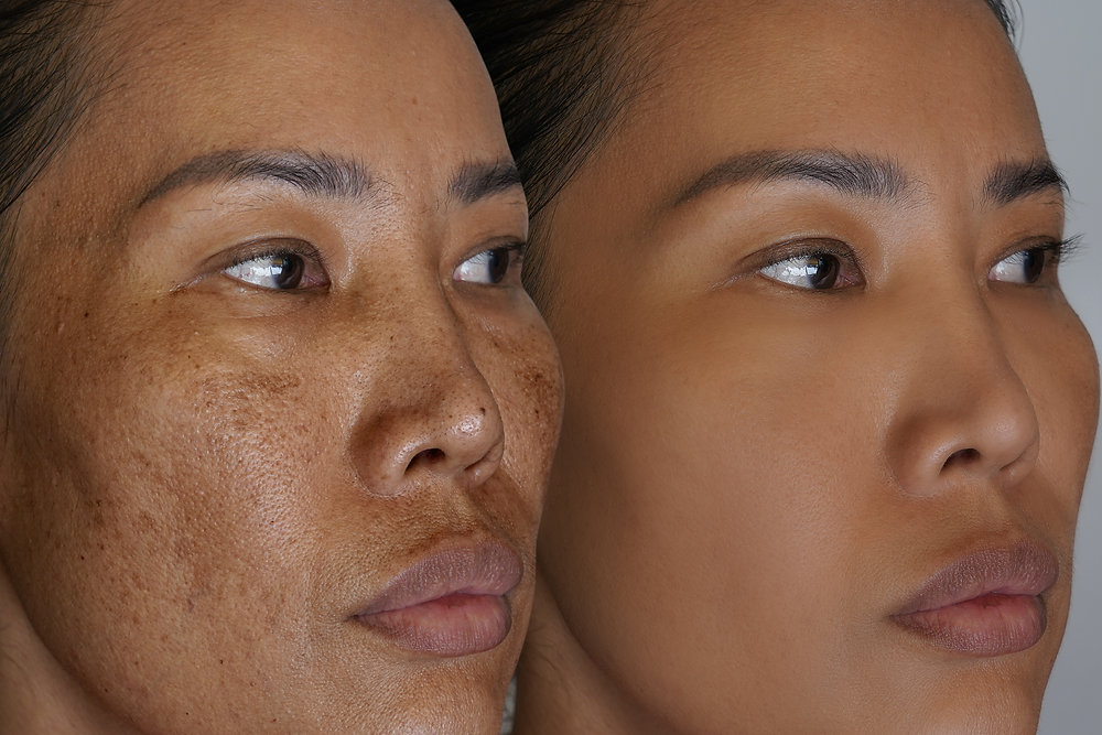 Understanding Hyperpigmentation: What It Means for Skin of Colour