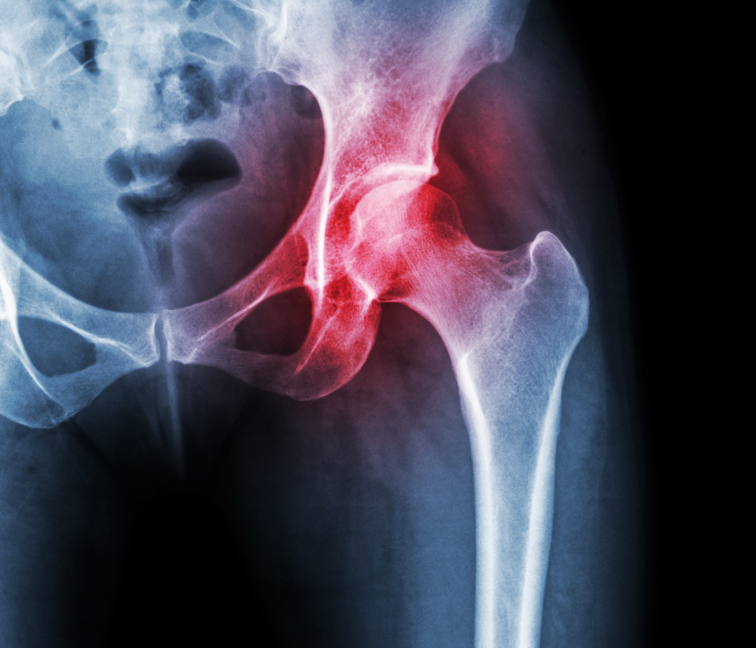 Hip Arthroscopy | Elizabeth Scott, MD