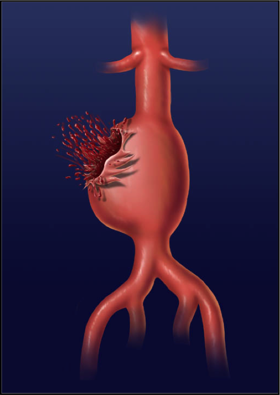 Aortic Aneurysm Aortic Stent Dissection
