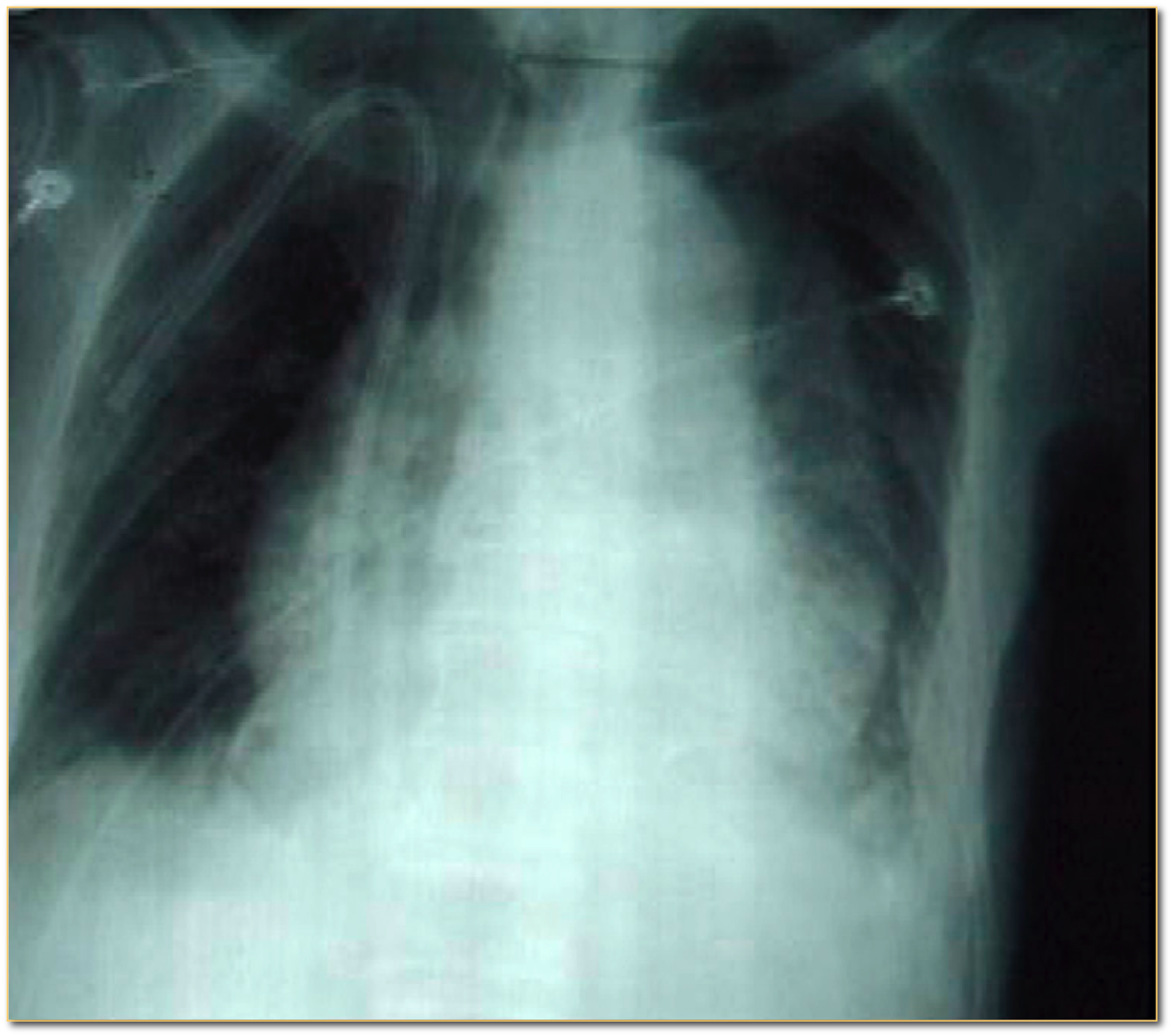 Aortic Aneurysm Case Study 1