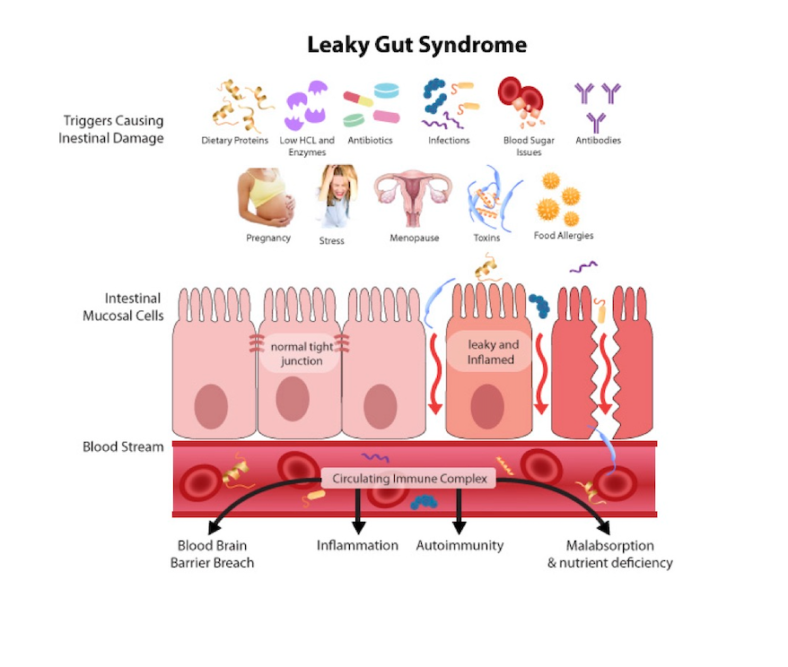 What is Intestinal Permeability (or Leaky Gut)?