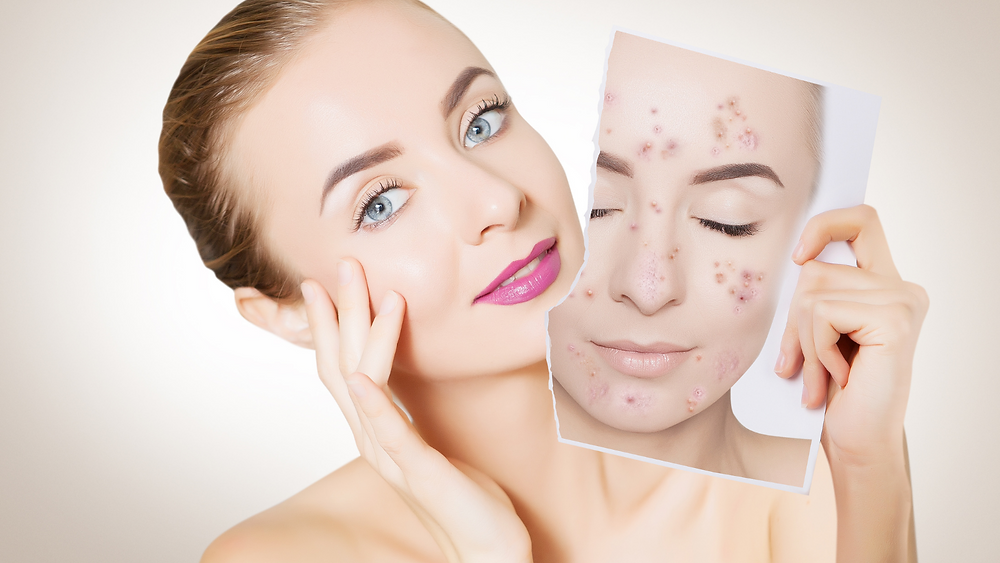 Grades of Acne: Understanding your breakouts to uncover your glow