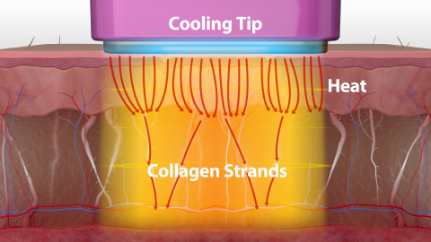 Thermage FLX | Youthful Medical Spa
