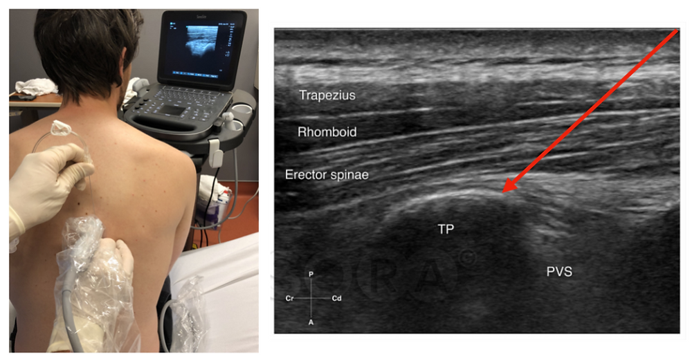 Erector Spinae Plane (ESP) block and Paravertebral Block (PVB): Key ...