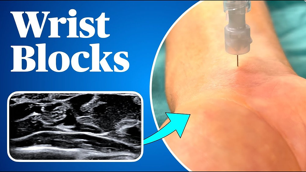 Mastering Wrist Nerve Blocks: Landmark & Ultrasound-Guided Approaches