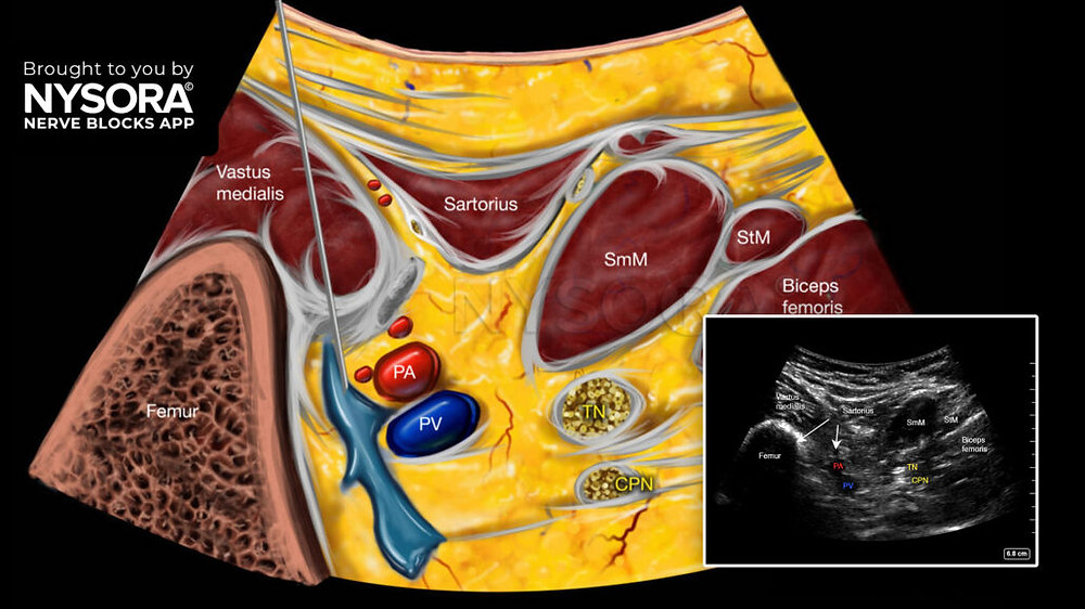 Understanding the iPACK Block: A Comprehensive Guide