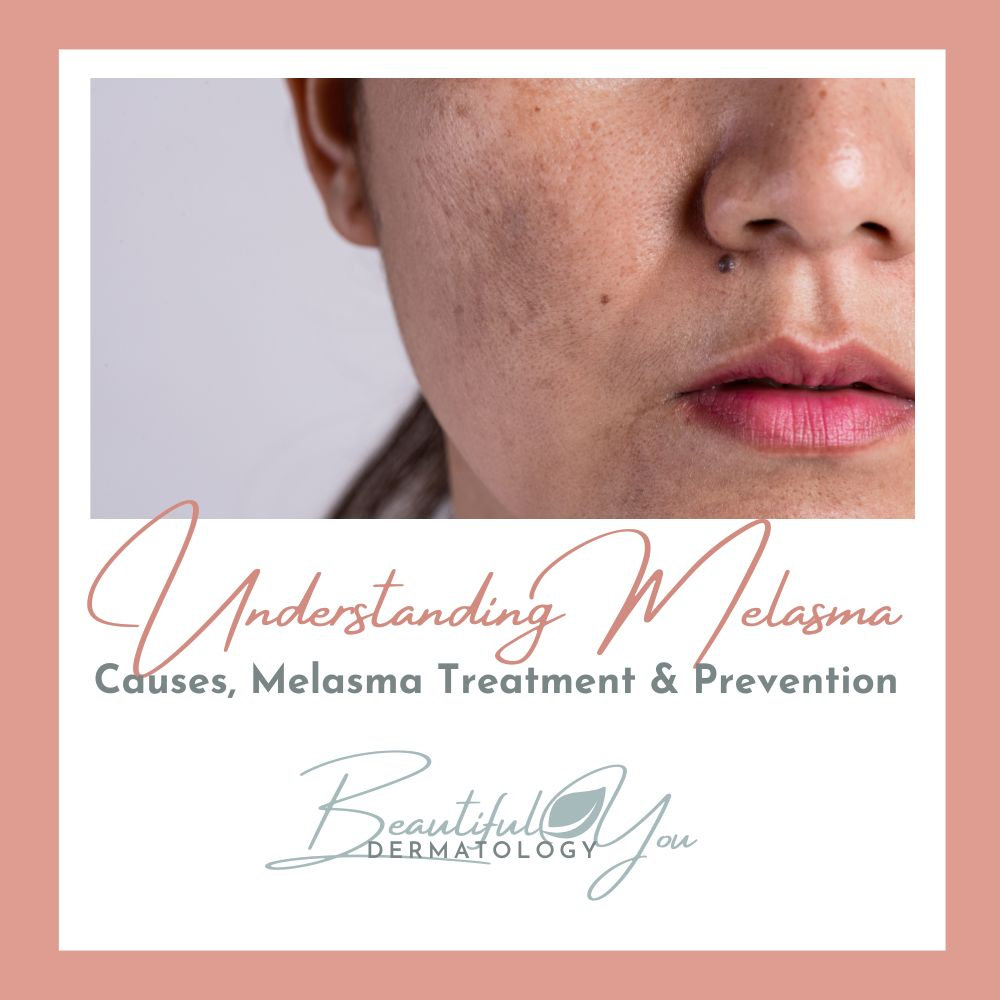 Understanding Melasma: Causes, Melasma Treatment & Prevention