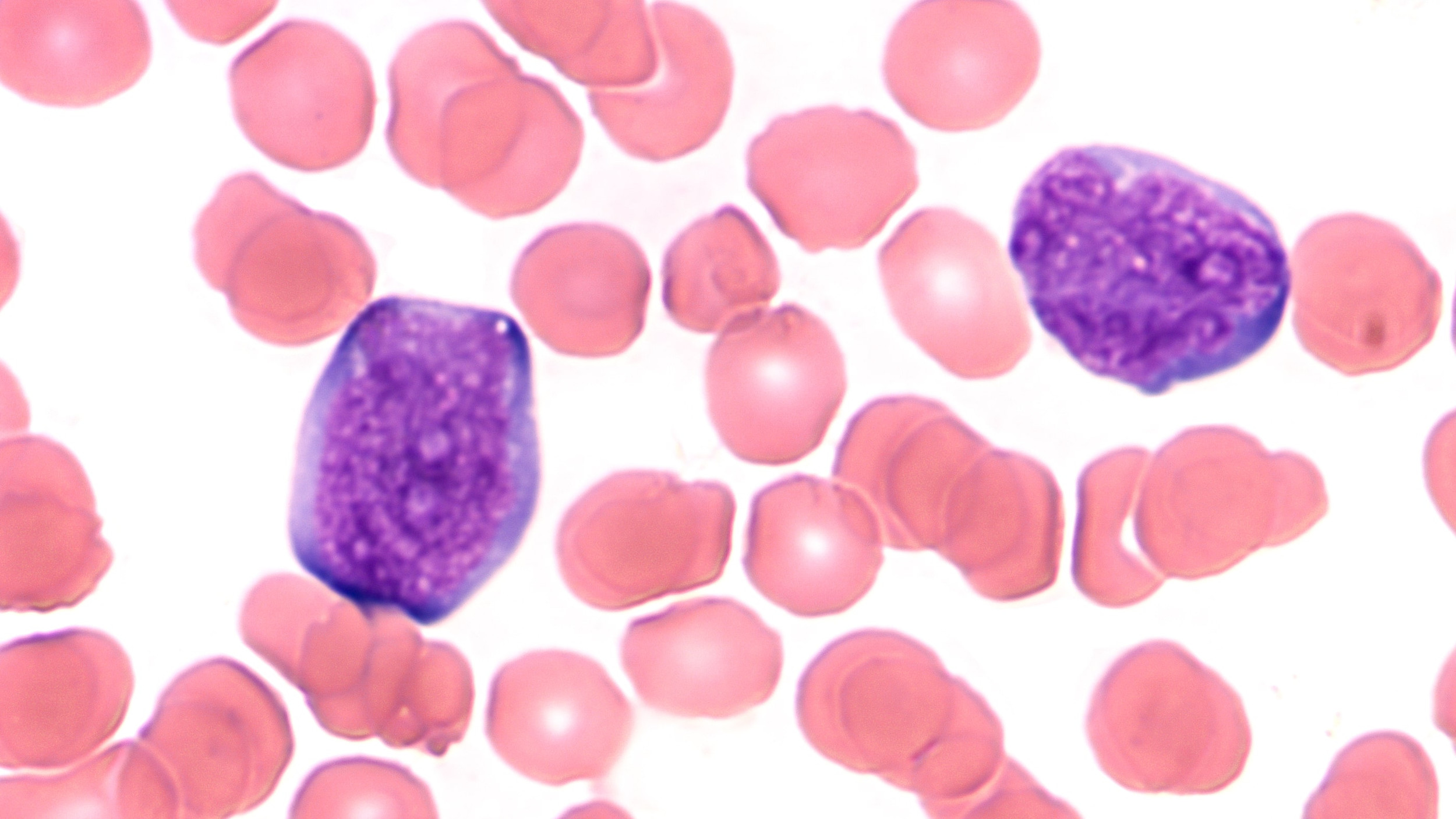 Acute lymphoblastic leukemia (ALL): Causes, symptoms and treatment ...