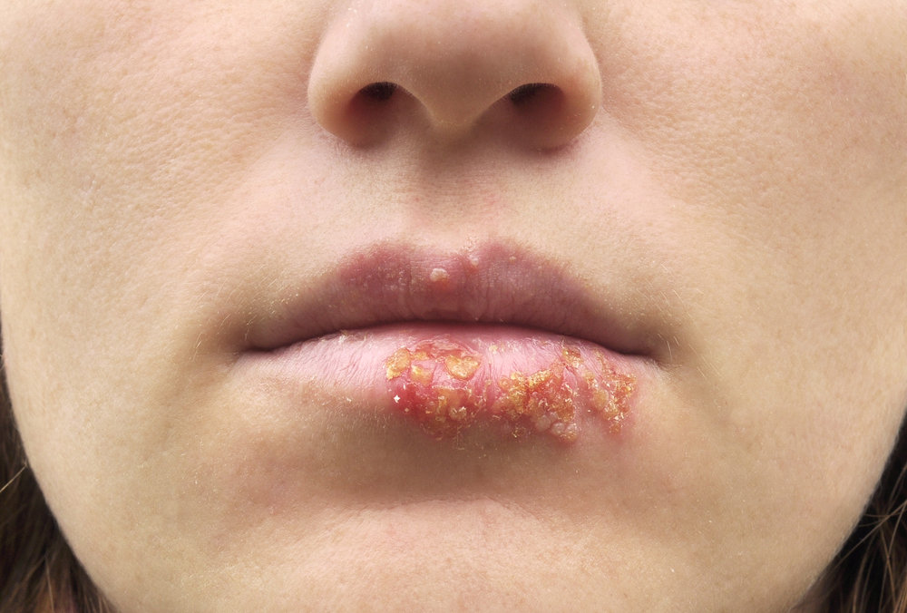 How to deal with cold sores in clinic