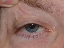 Lift Sagging Eyelids with Ultrasound