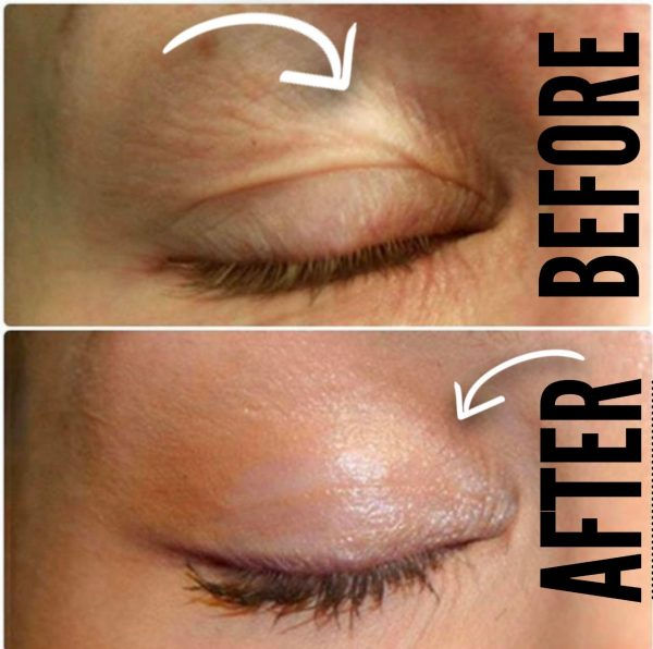 Lift Sagging Eyelids with Ultrasound