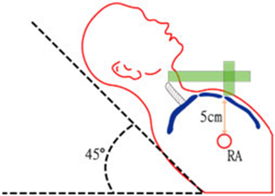 THE VENOUS PULSE AND THE WAVEFORMS