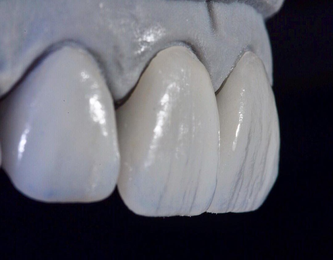 Aesthetics | Advanced Dental Laboratory Maria Spanopoulou | Athens