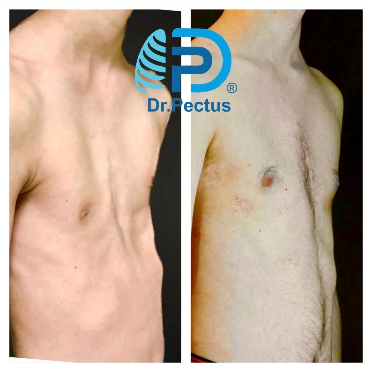 Platythorax - Anteroposterior Flattening⎮ Dr.Pectus