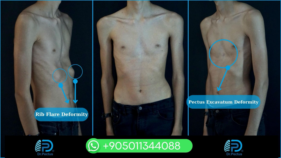 Is there a solution for "Rib Flare" deformities accompanying pectus ...