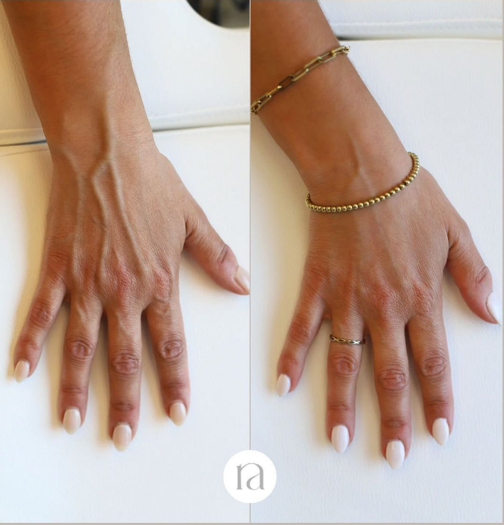 Injection | Radiance Médico-esthétique | Longueuil