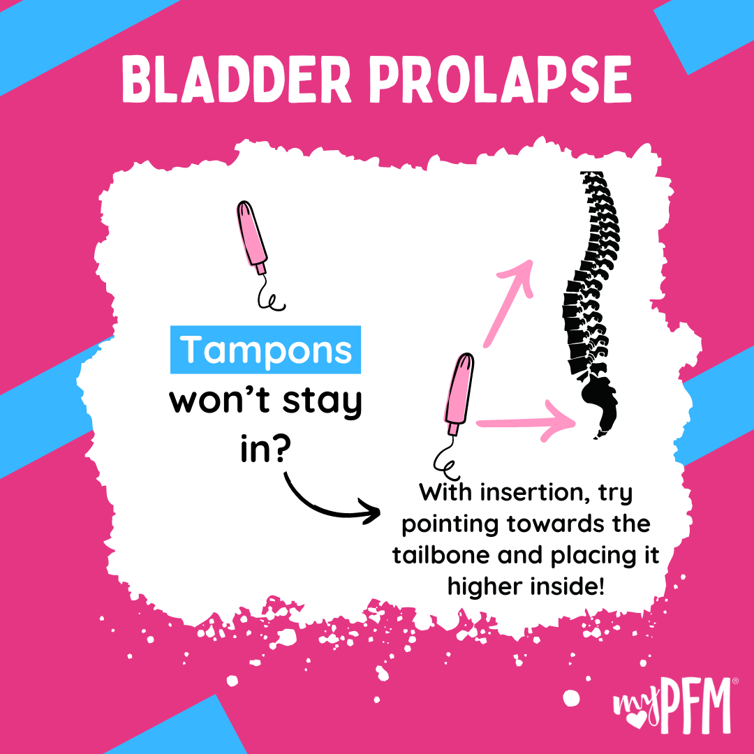 Bladder Prolapse: Tampons