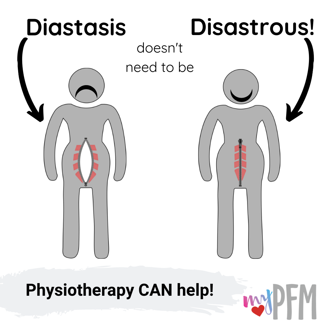 Diastasis