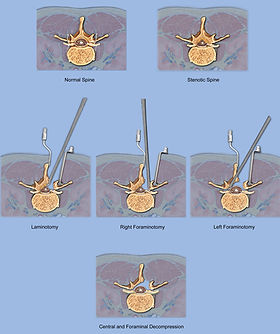 laminectomy decompression discectomy