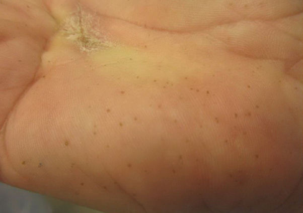 Getting to the point – a case of spiny keratoderma