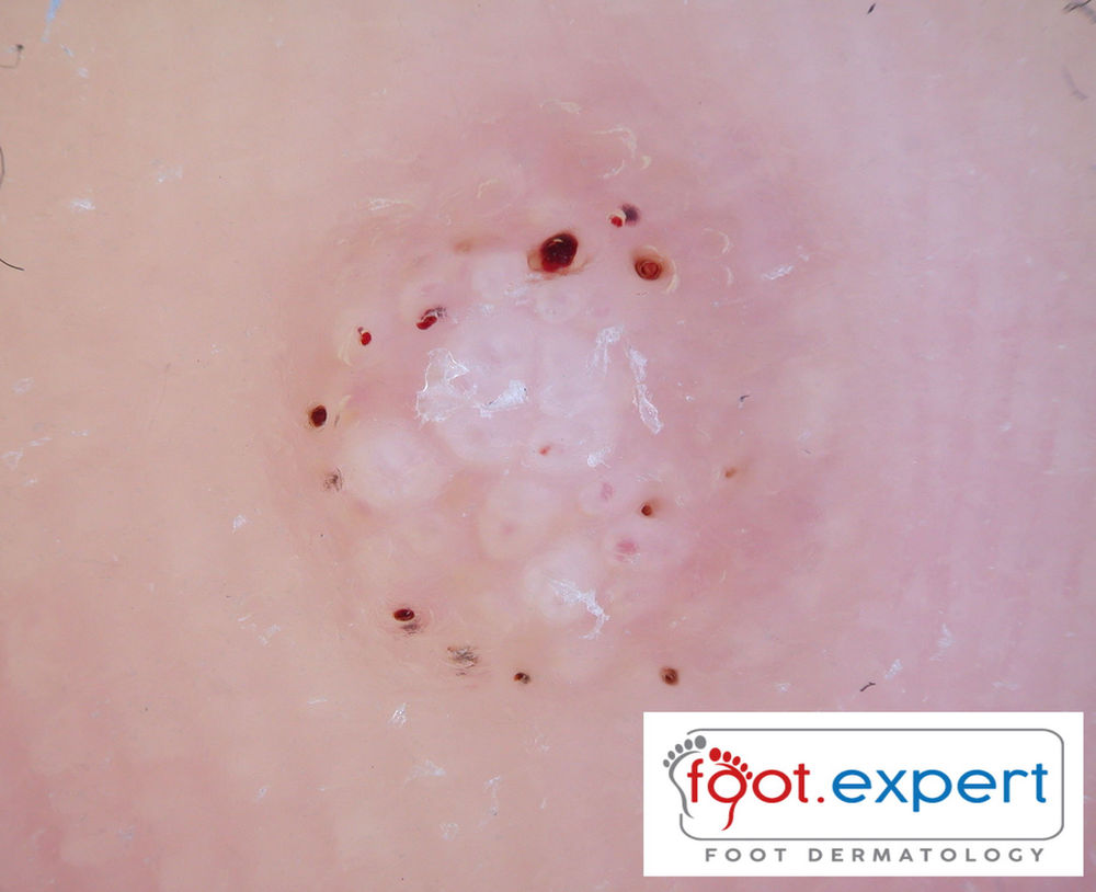 Dermoscopy of Warts & Corns