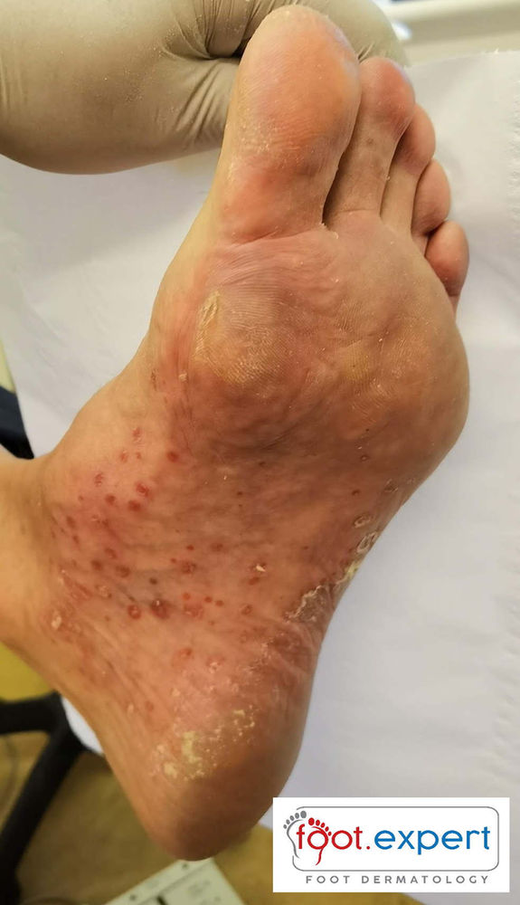 Palmoplantar Pustulosis or Psoriasis?