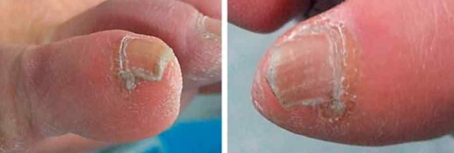 Durlacher's corn. Skin or nail?