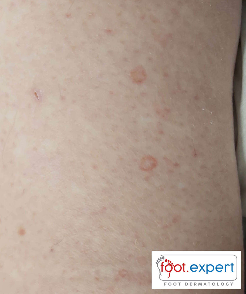 Porokeratosis - two cases