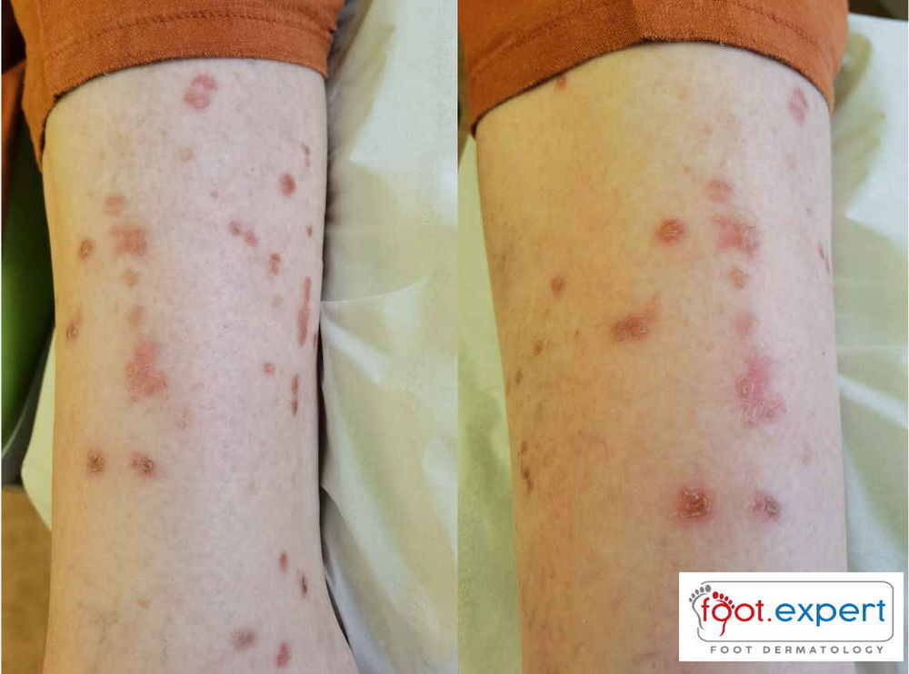 Porokeratosis - two cases