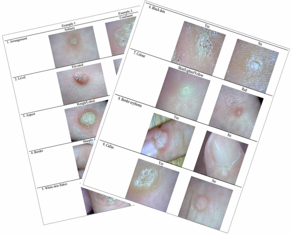 Clinical Classification of Warts