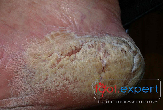 hyperkeratinization treatment