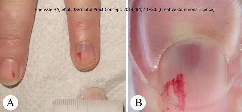 Why does my toenail hurt?