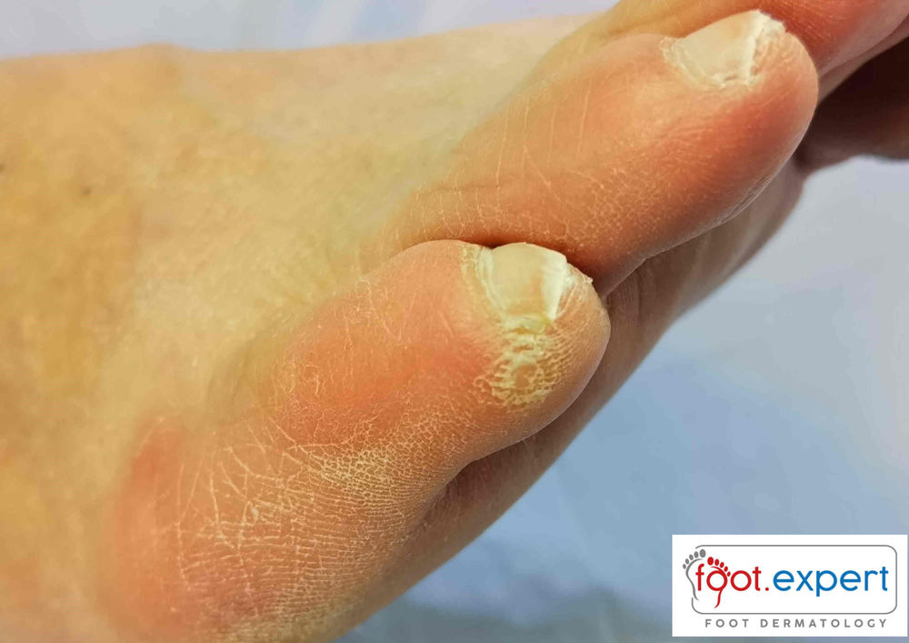 Durlacher's corn. Skin or nail?