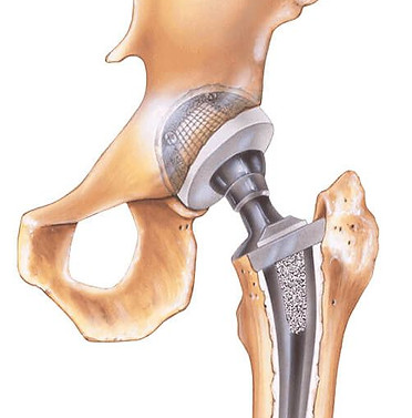 Affordable Hip Replacement Surgery in Costa Rica | MedforLess