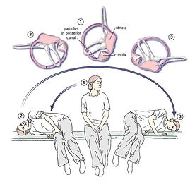 le principali cause di vertigine periferica