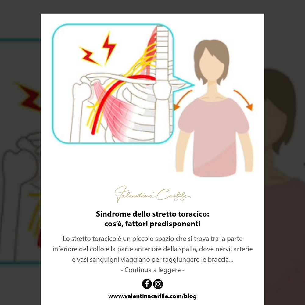 Thoracic outlet syndrome: what it is, predisposing factors