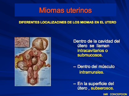 Miomas Uterinos | laparoscopia