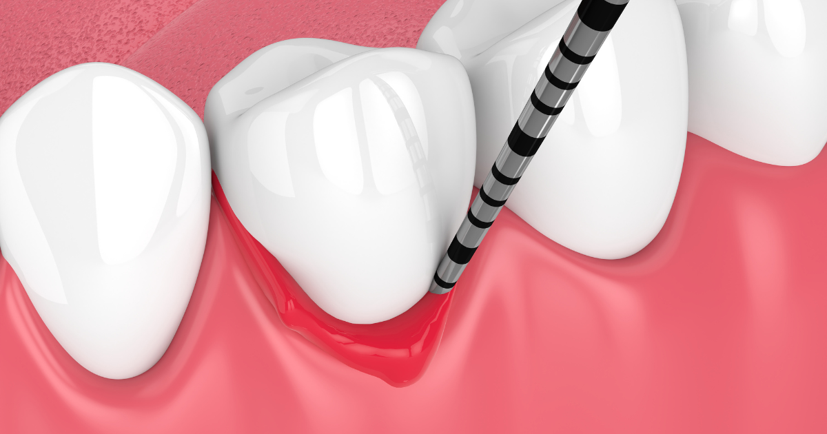 ARESTIN® Treatment in Upland and Fontana | Imaging Dentistry
