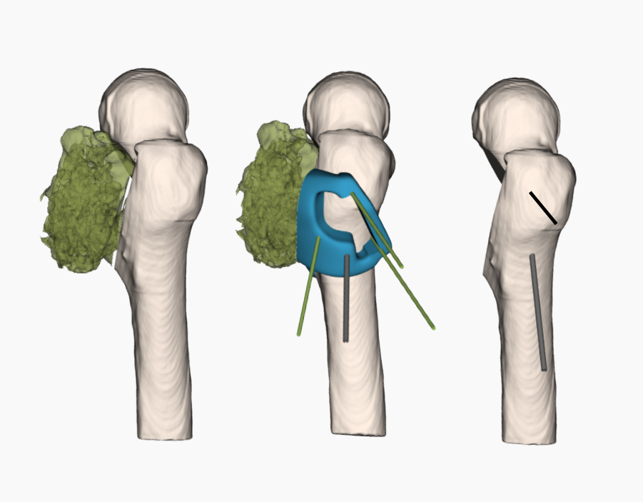 Patient-Specific Surgical Guide for Low-Grade Bone Lesion Resection ...