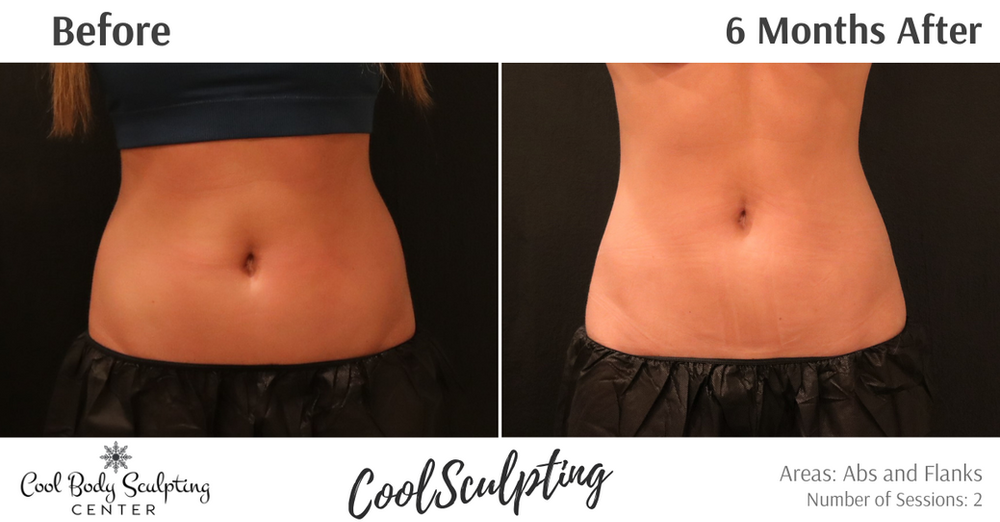 My CoolSculpting Journey with Cool Body Sculpting Center