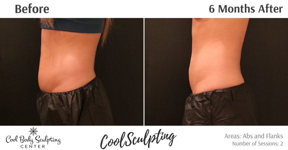 My CoolSculpting Journey with Cool Body Sculpting Center